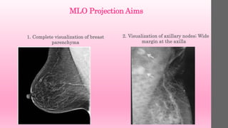 Mammography positioning technique for MLO View | PPTX