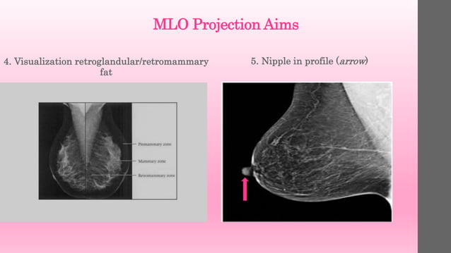 Mammography positioning technique for MLO View | PPTX | Death, Injury ...