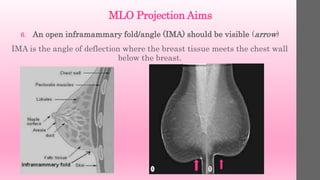 Mammography positioning technique for MLO View | PPTX