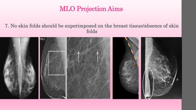 Mammography positioning technique for MLO View | PPTX | Death, Injury ...
