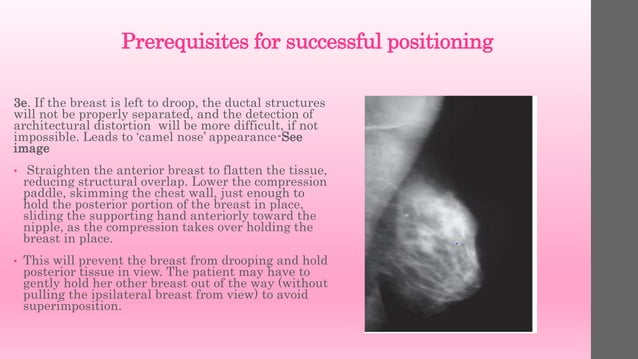 Mammography positioning technique for MLO View | PPTX | Death, Injury ...