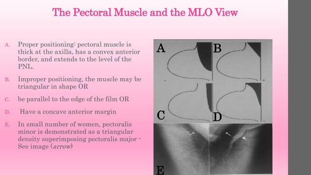 Mammography positioning technique for MLO View | PPTX | Death, Injury ...