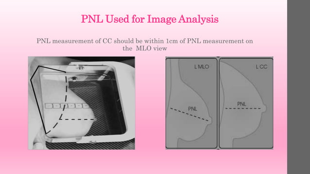 Mammography positioning technique for MLO View | PPT