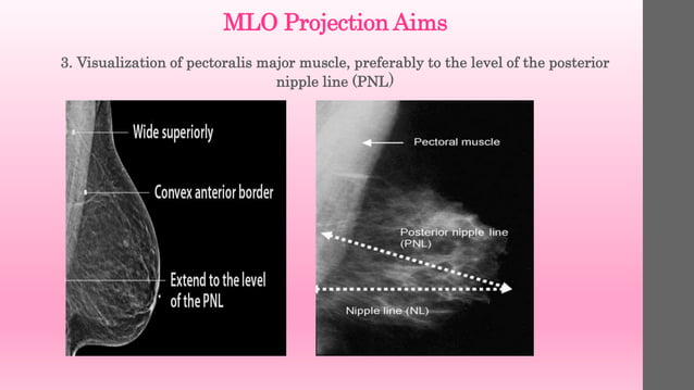 Mammography positioning technique for MLO View | PPT