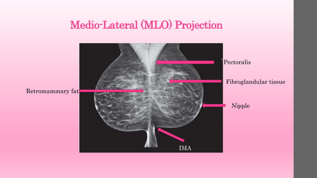 Mammography positioning technique for MLO View | PPT