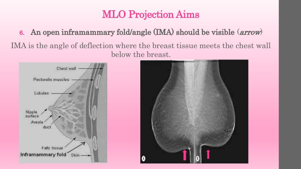 Mammography positioning technique for MLO View
