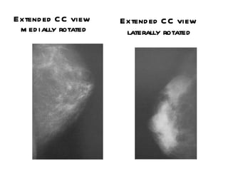 Mammography presentation | PPT