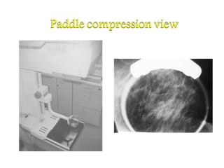 Mammography presentation | PPT