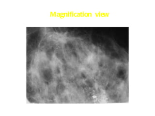 Mammography presentation | PPT
