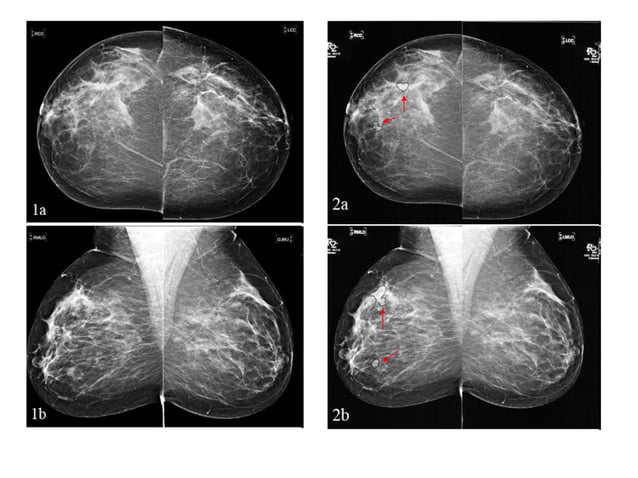 Mammography presentation | PPT