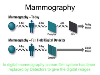 Mammography presentation | PPT