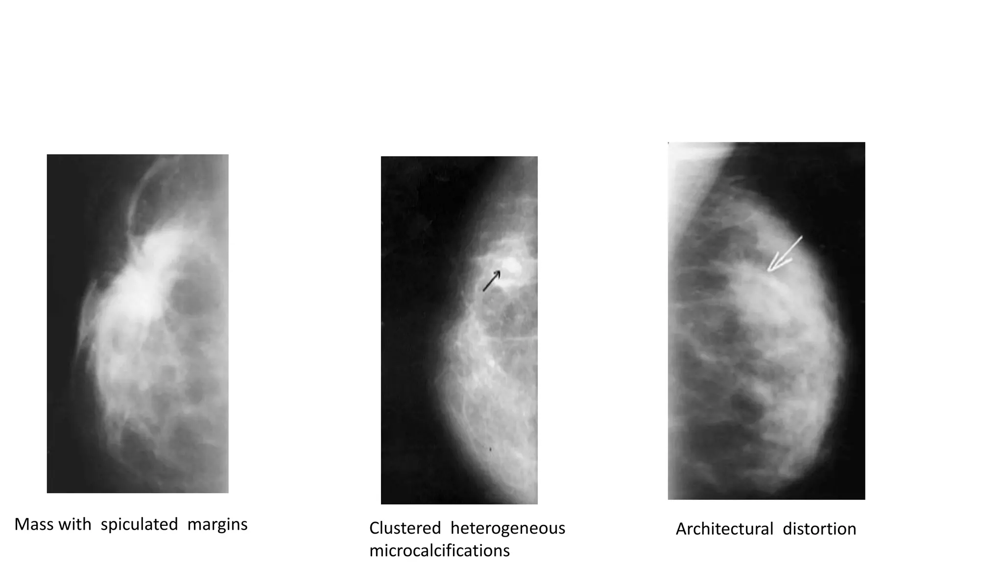 Mammography | PPTX
