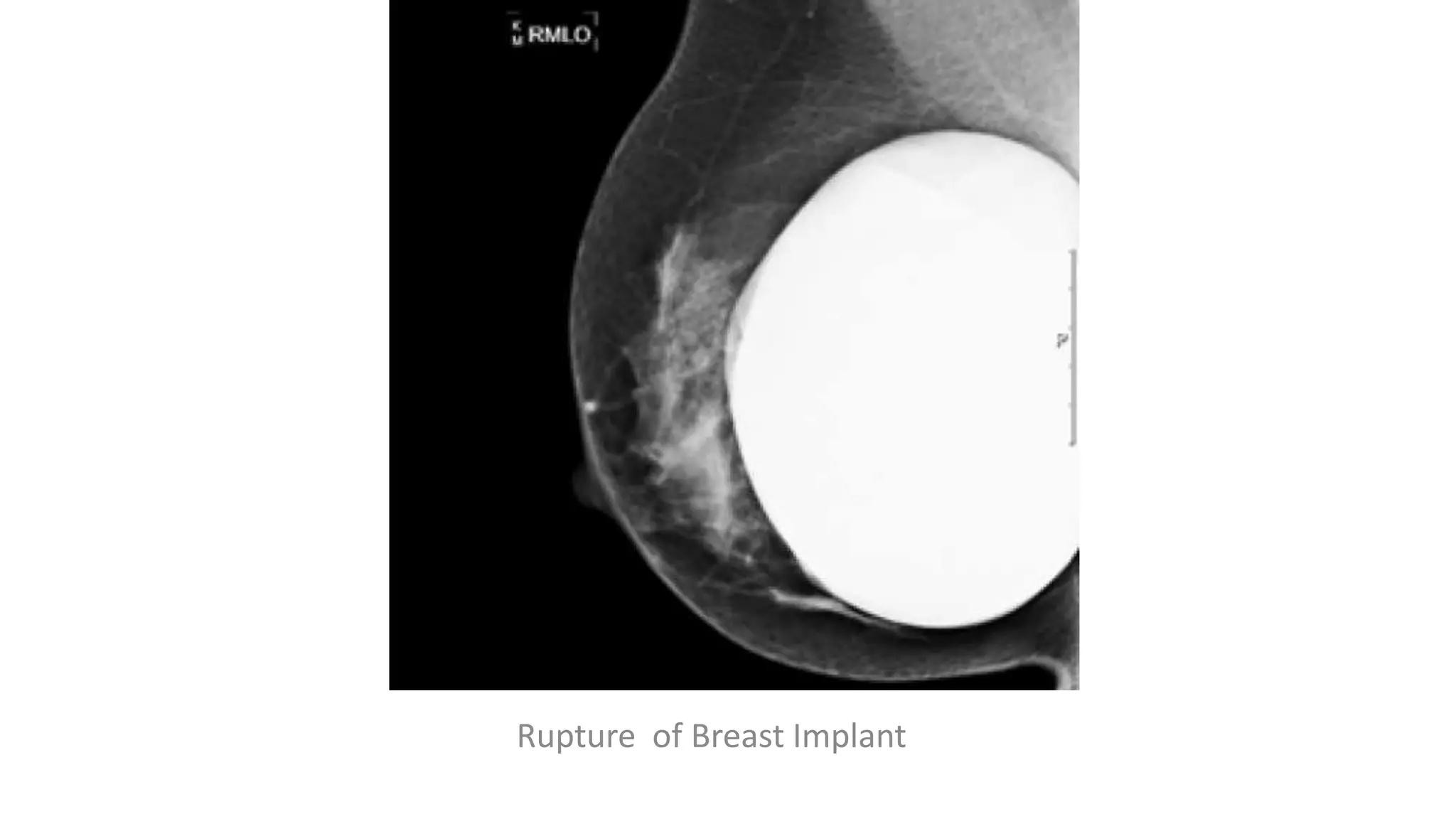Mammography | PPTX