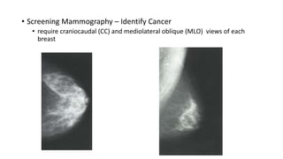 Mammography | PPTX