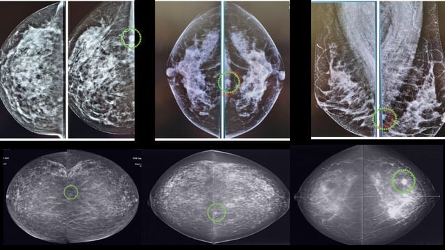 MammoGRIP Overview - Dr. Andre DeSimone, Bioflex | PPTX | Cancer ...