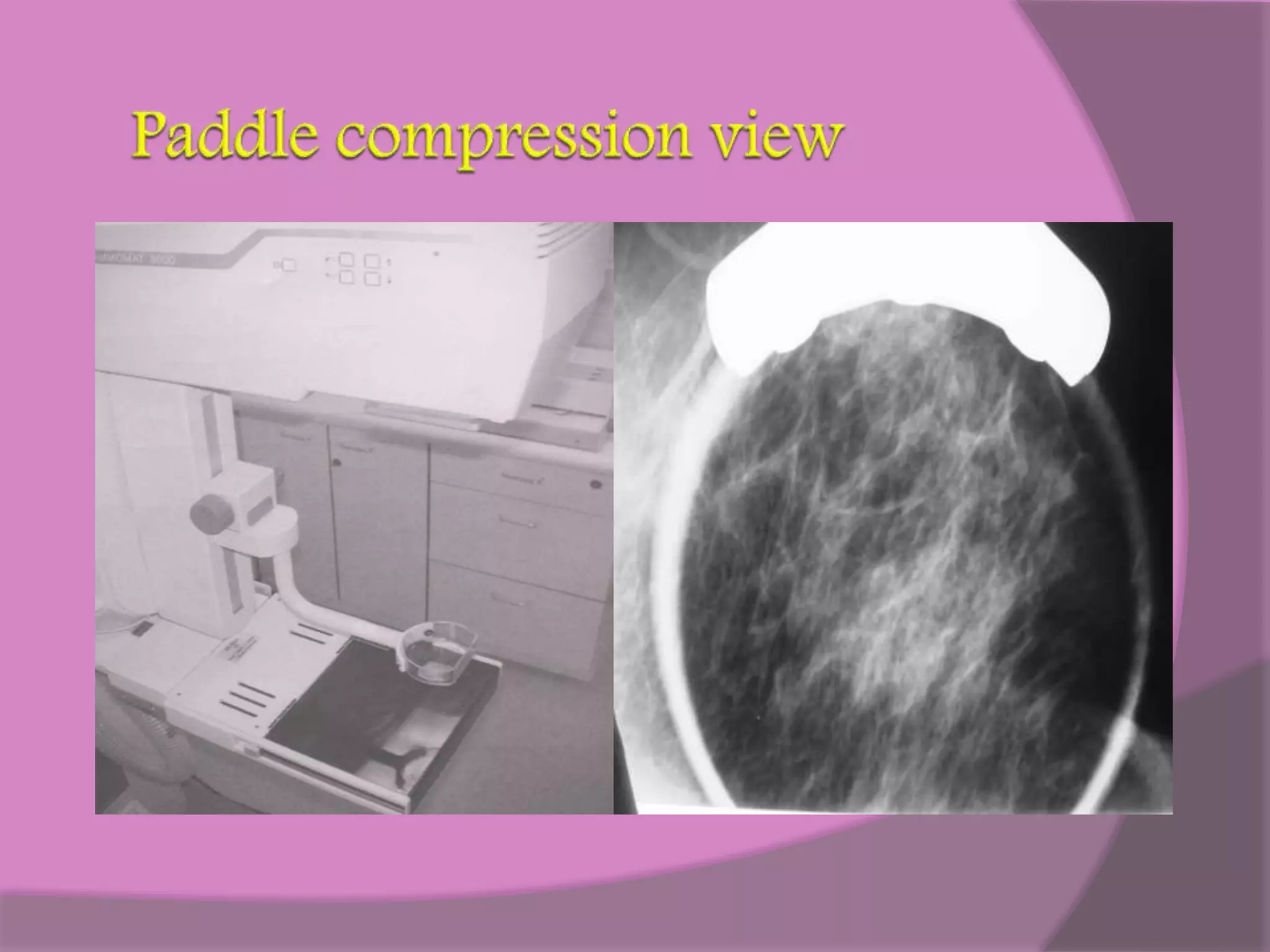 Mammography | PPTX