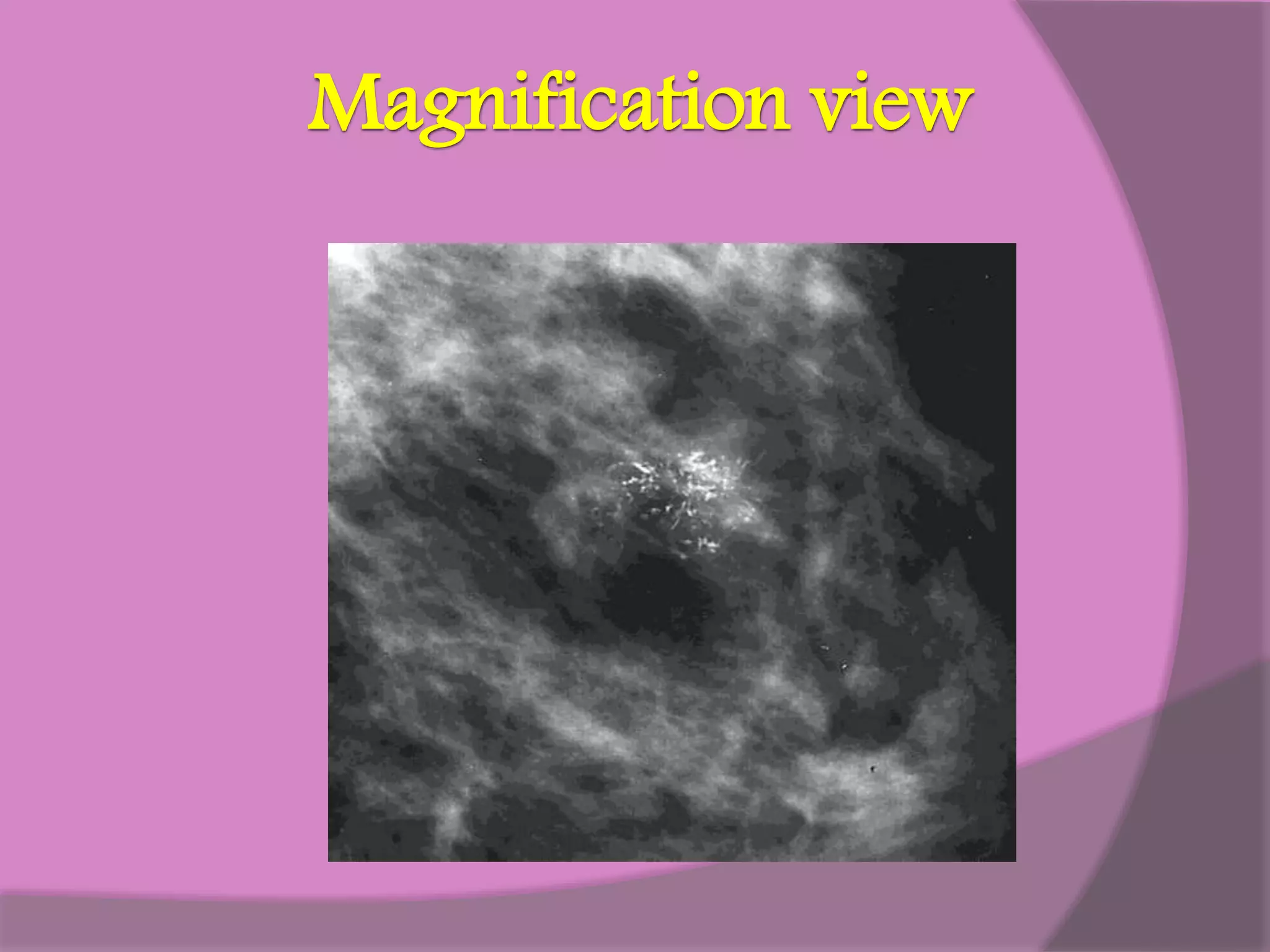 Mammography | PPTX
