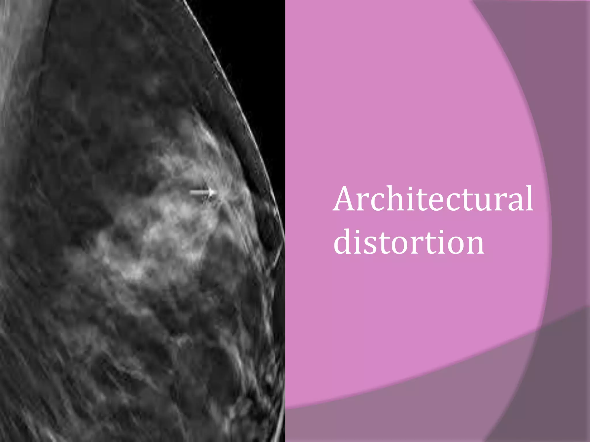 Mammography | PPTX