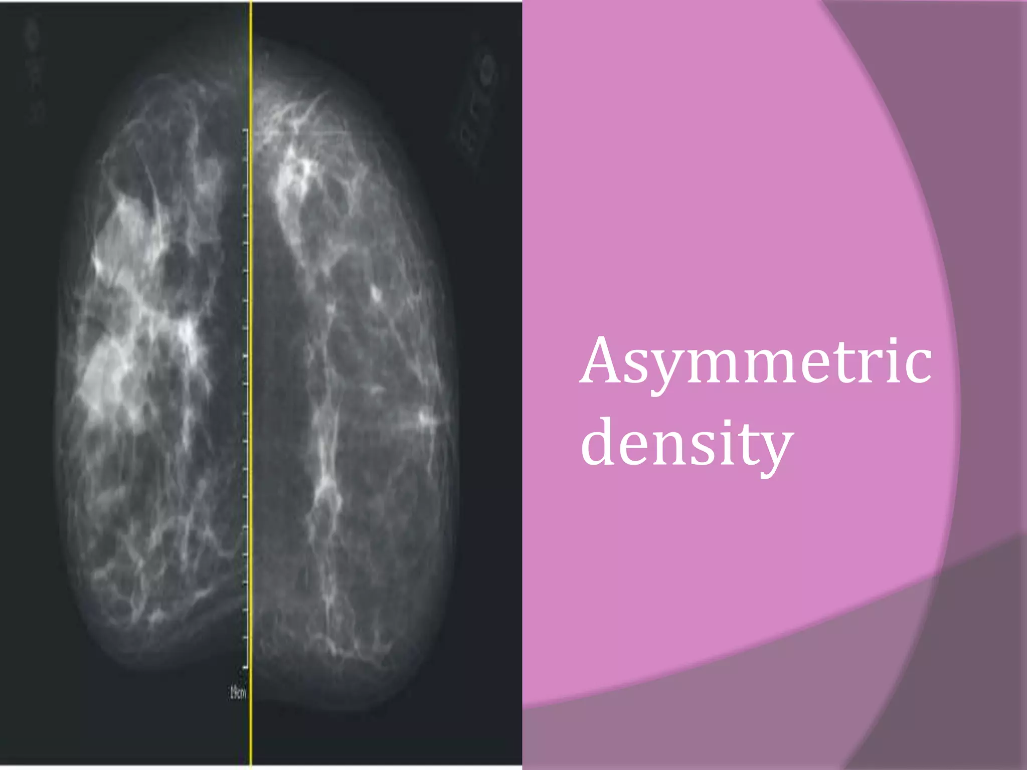 Mammography | PPTX