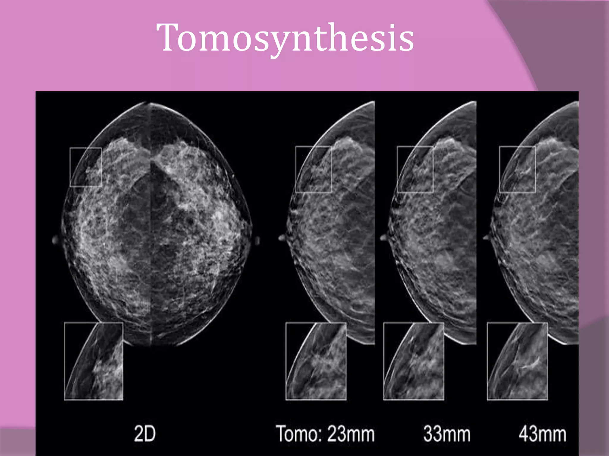 Mammography | PPTX