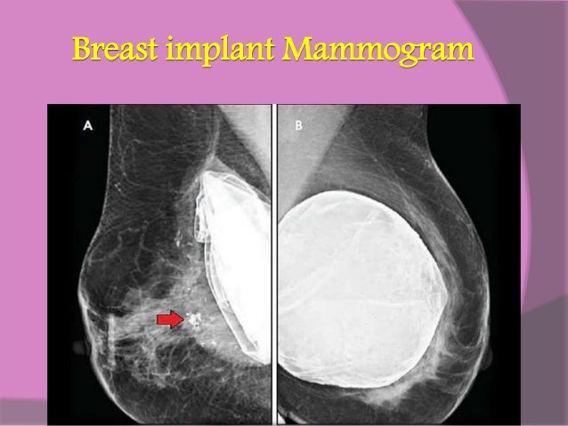 Mammography