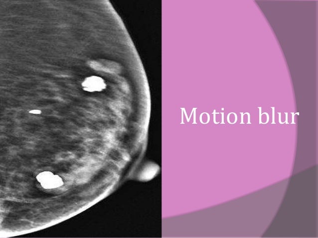 Mammography