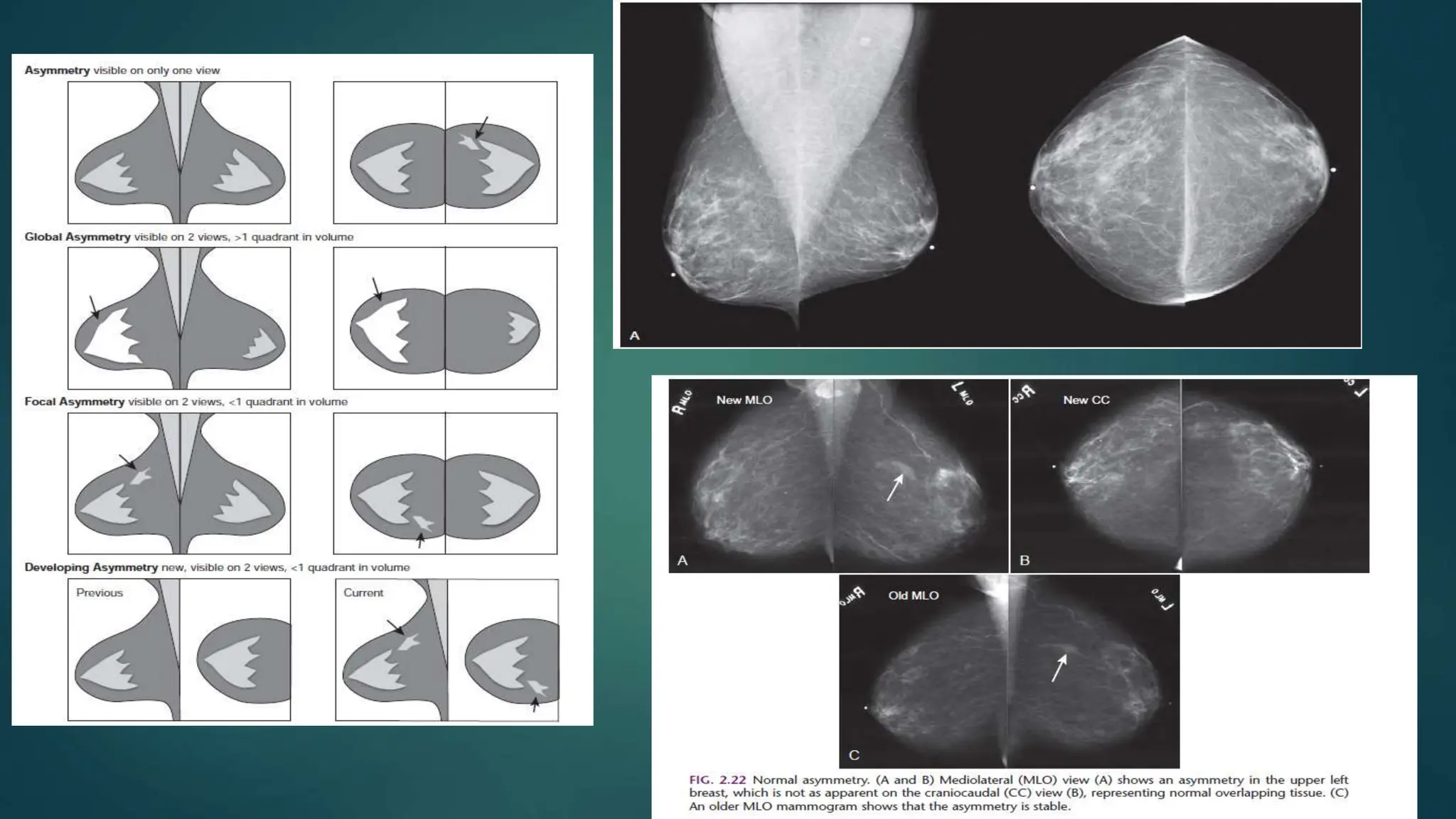 Mammography -A ppt bt J K PATIL, Prof,dept of radiology | PPTX