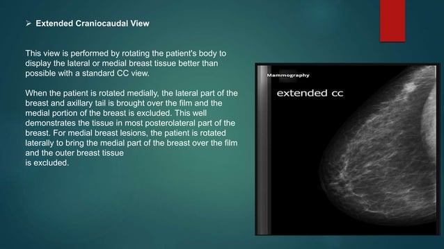 Mammography -A ppt bt J K PATIL, Prof,dept of radiology | PPT