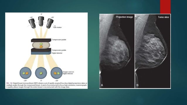 Mammography -A ppt bt J K PATIL, Prof,dept of radiology | PPTX