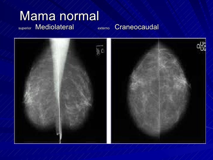 Mamografia