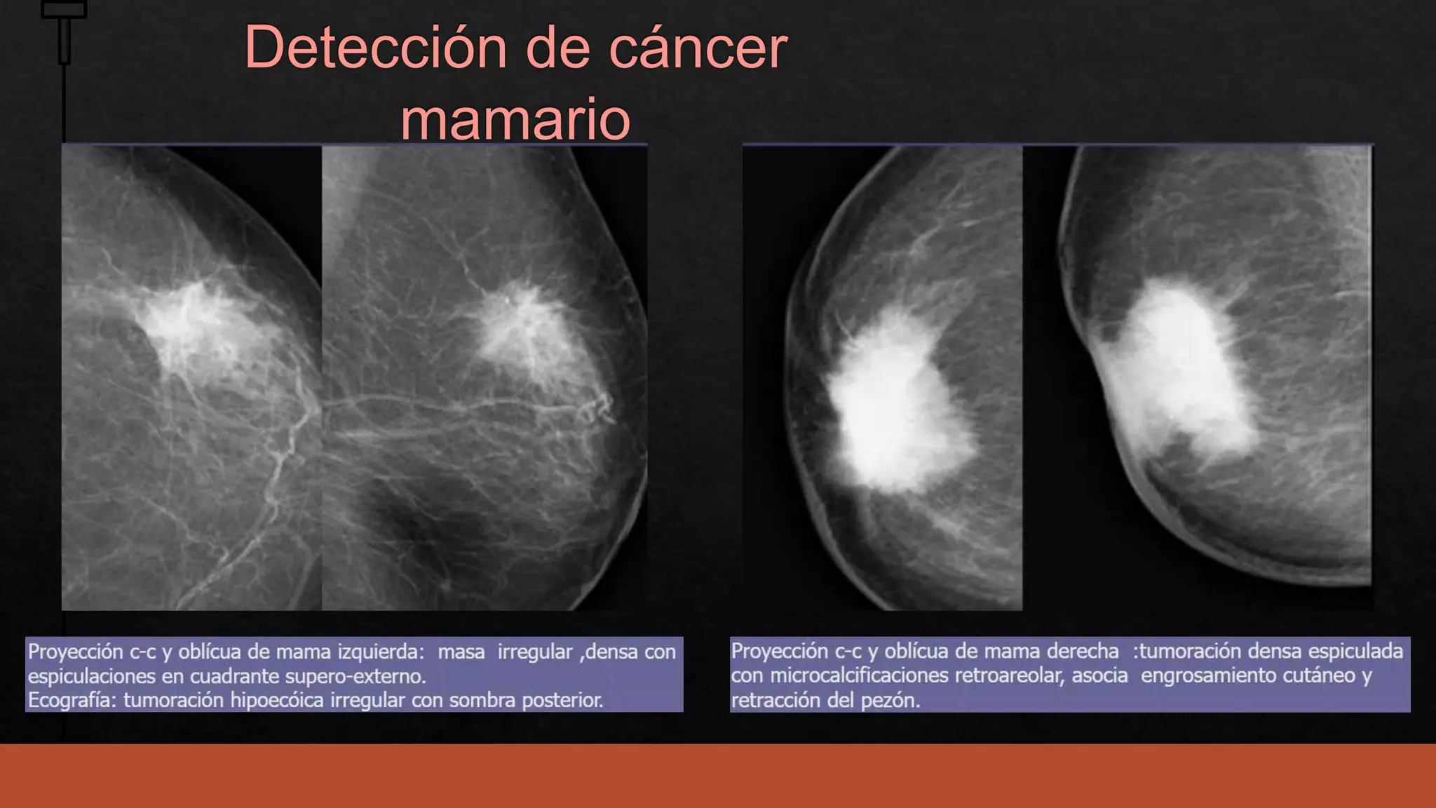 MAMOGRAFIA NORMAL.pptx