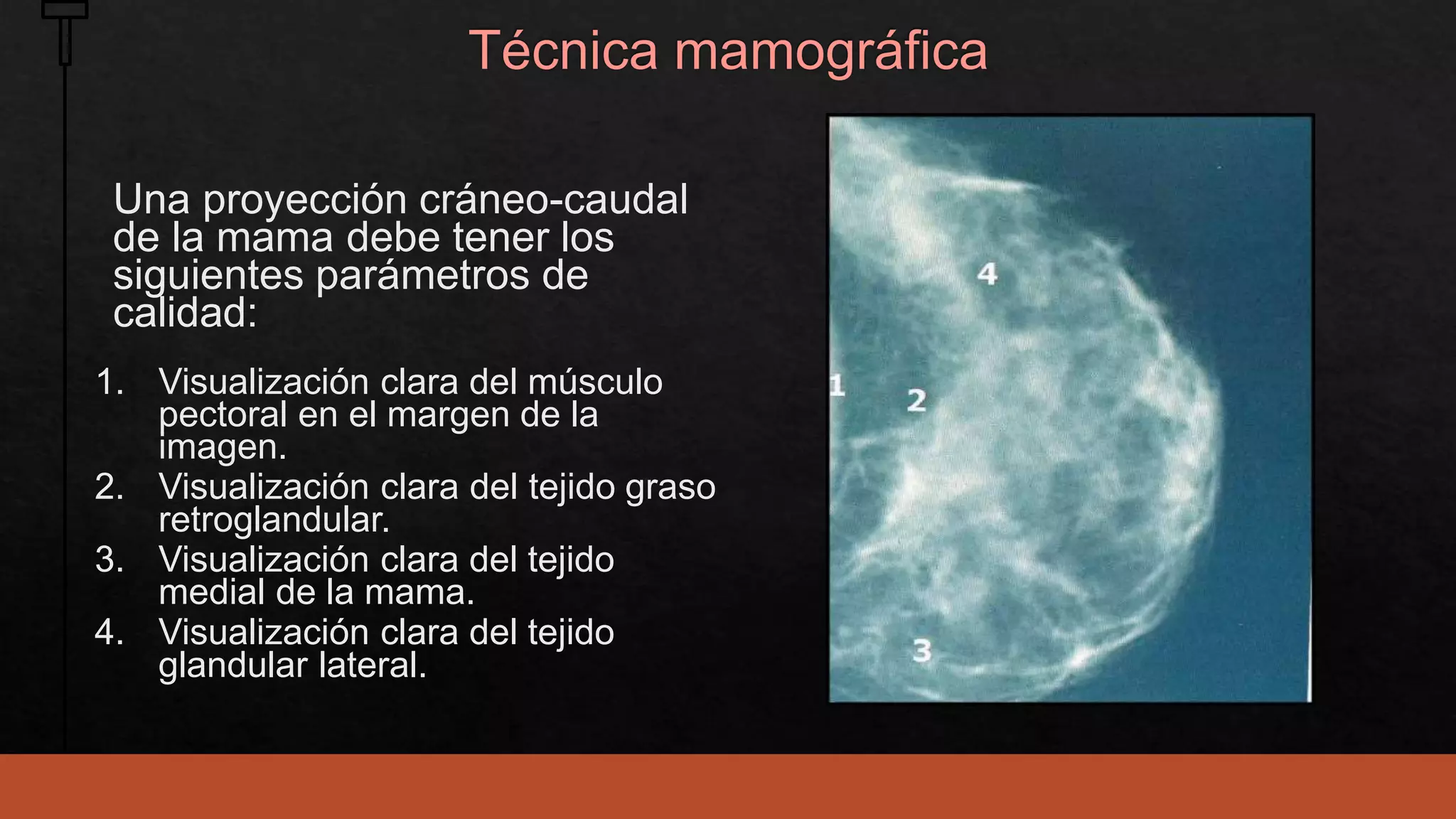 MAMOGRAFIA NORMAL.pptx
