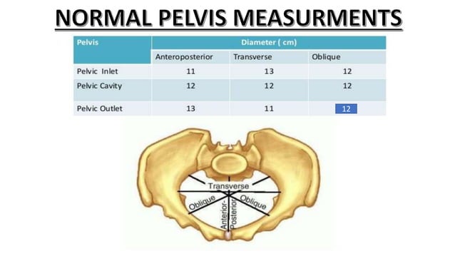 Contracted pelvis | PPTX | Pregnancy | Reproductive Health