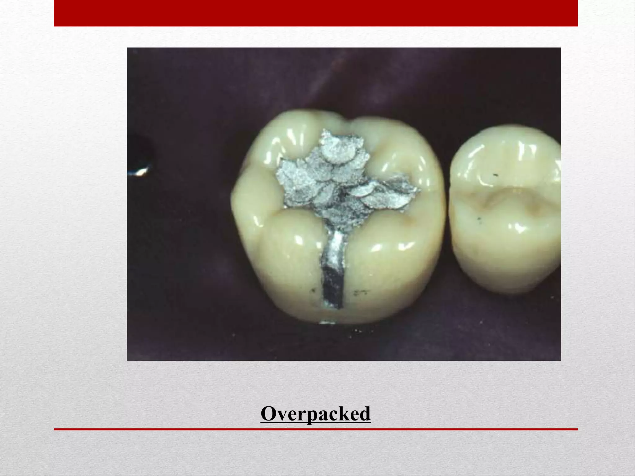 procedure for amalgam restoration | PPTX
