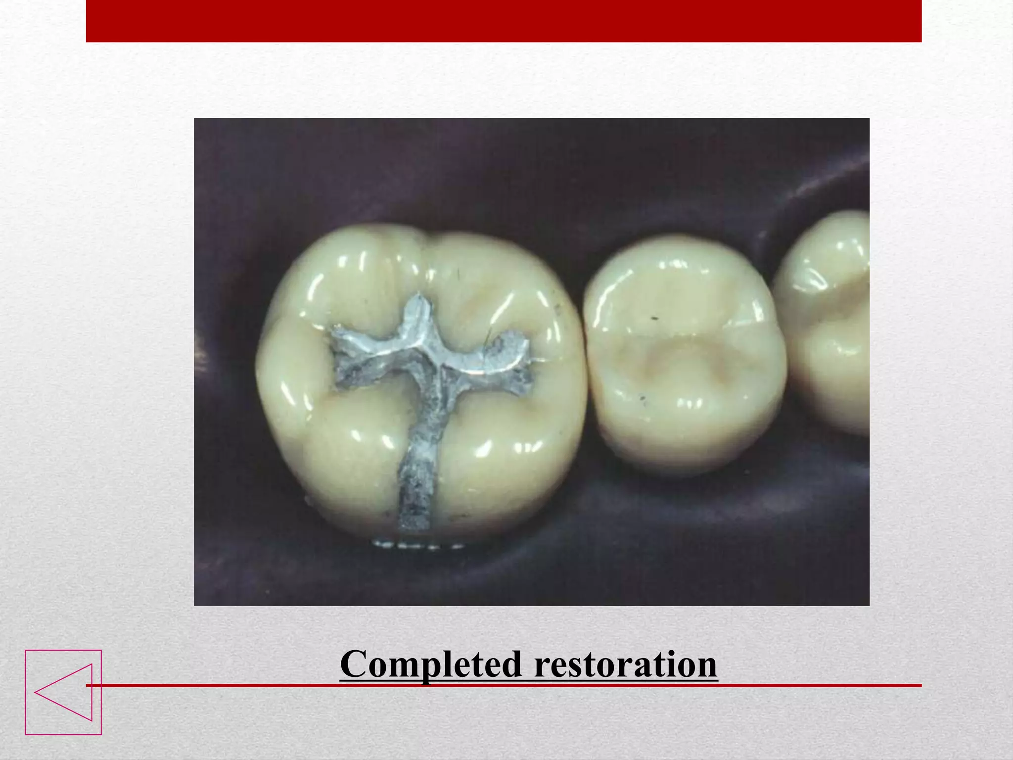procedure for amalgam restoration | PPTX