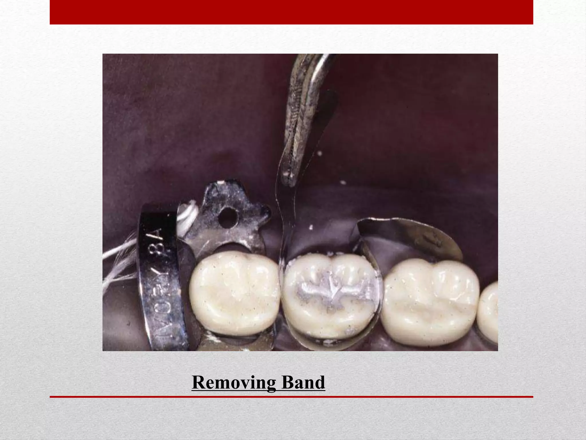 procedure for amalgam restoration | PPTX