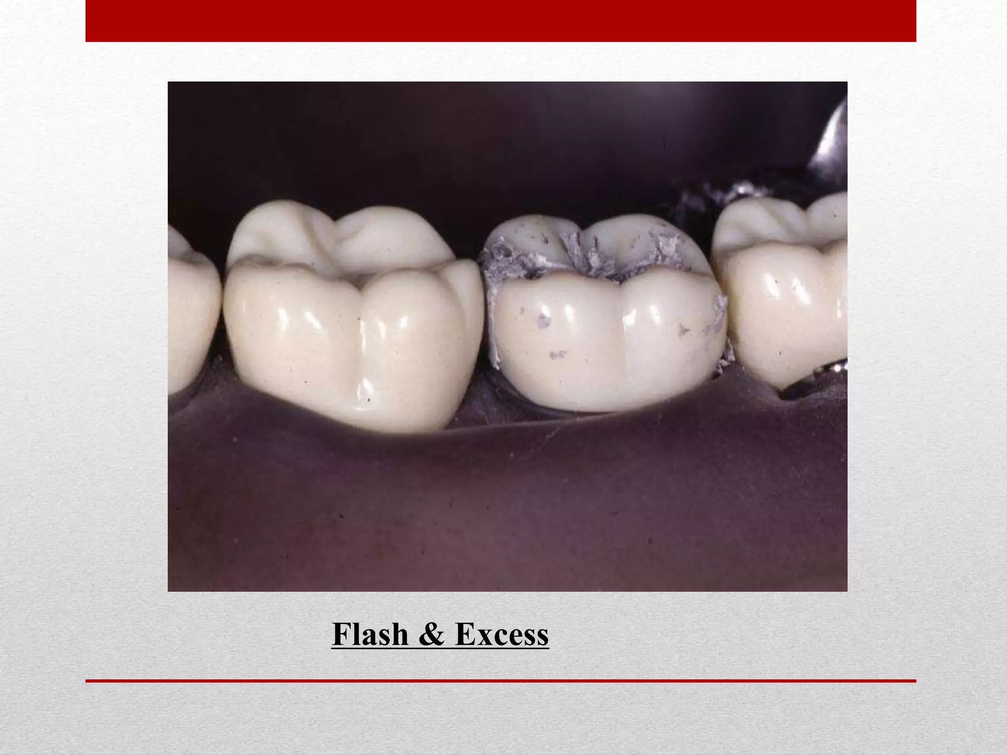 procedure for amalgam restoration | PPTX