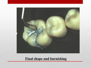 procedure for amalgam restoration | PPTX