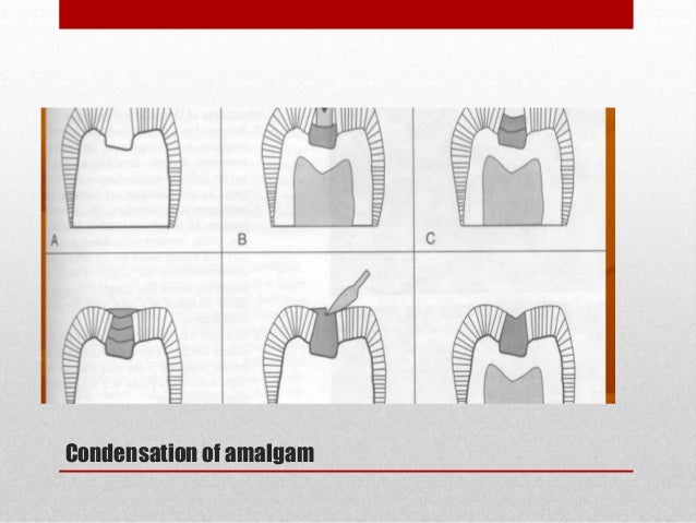 procedure for amalgam restoration