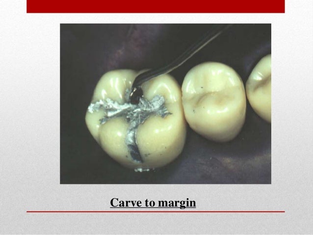 procedure for amalgam restoration