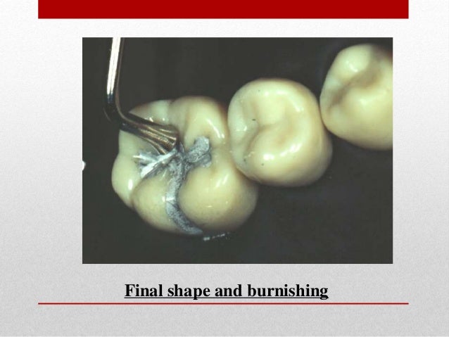 procedure for amalgam restoration