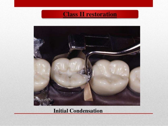 Do Amalgam Restoration On 30