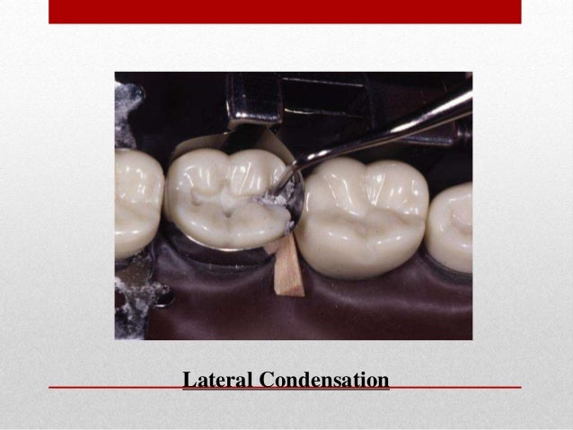 procedure for amalgam restoration