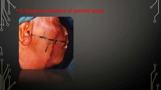 Management salivary gland disease .pptx