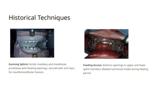 Management-of-Atrophic-Mandible-Fractures.pptx