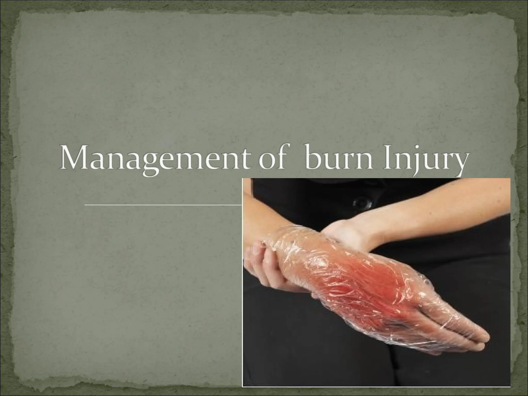 management-of-burn-injury2.ppt hhhhhhhhhhh | PPT