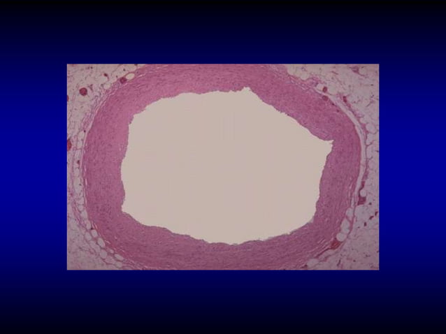 Management-of-CAD.ppt | Heart and Cardiovascular Diseases | Diseases ...