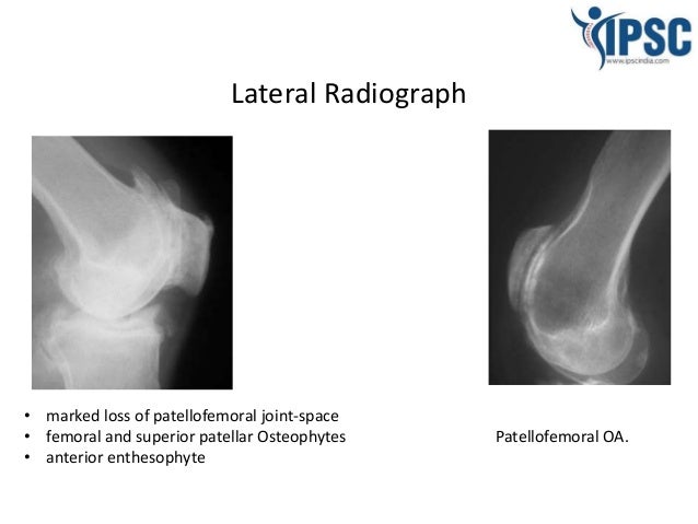 Management of chronic knee pain