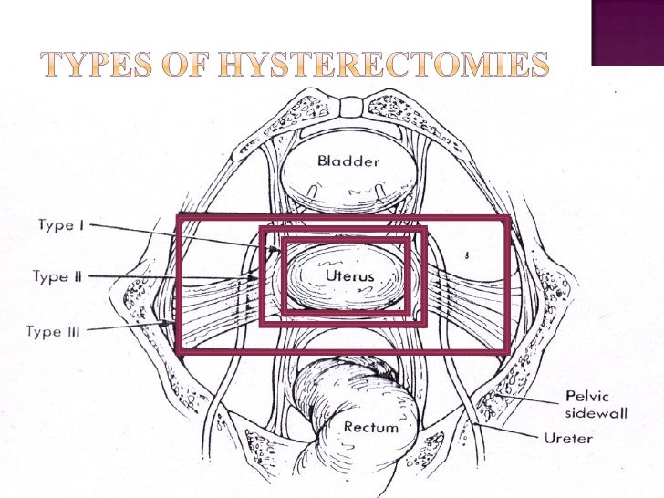 Management Of Early Stage Ca Cervix [Autosaved]