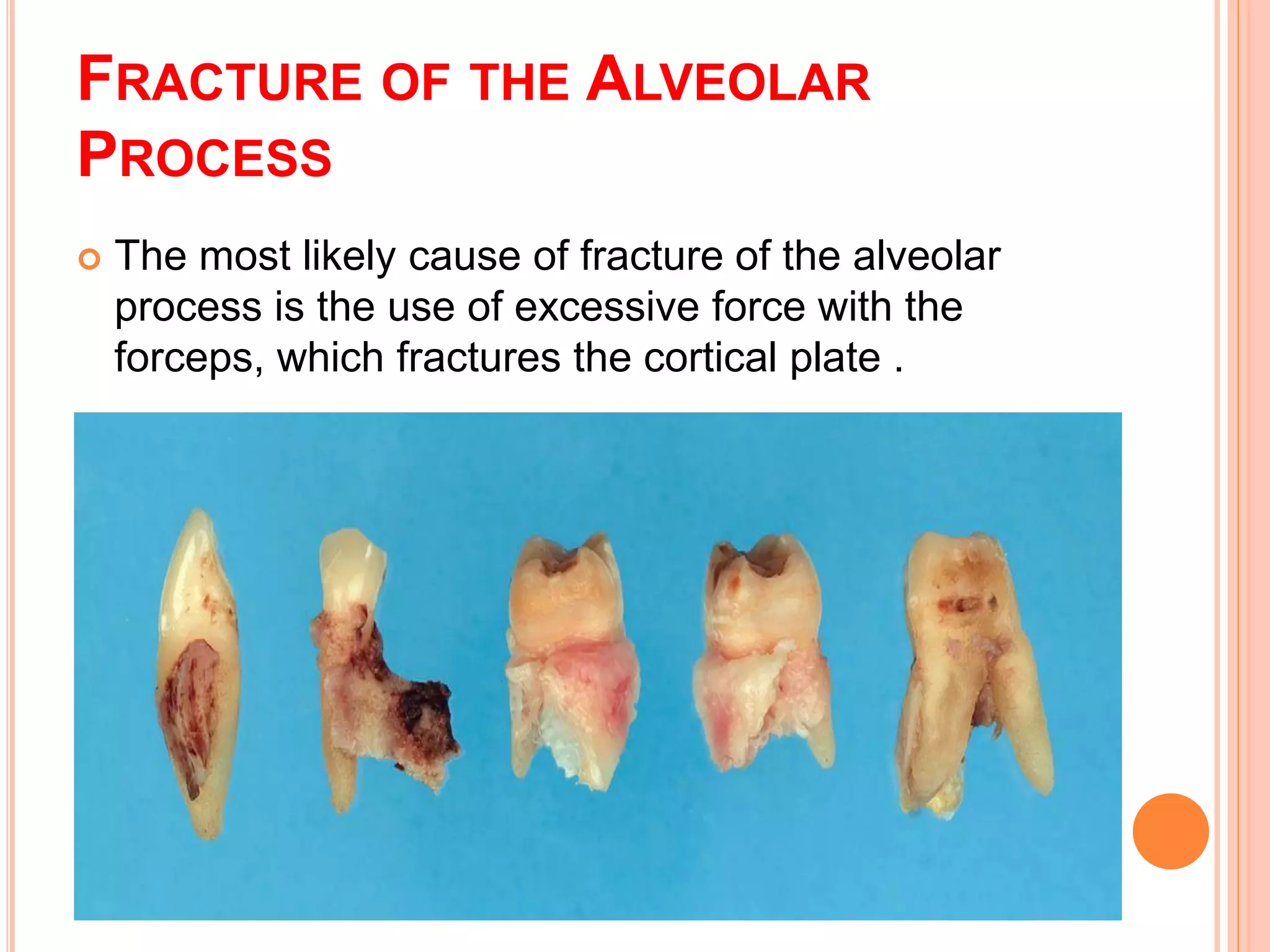 Management of-extraction-complications | PPSX